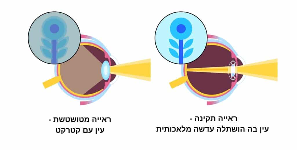 מומחה קטרקט - רופא עיניים, מנתח בכיר: ד"ר אליק רוזנפלד