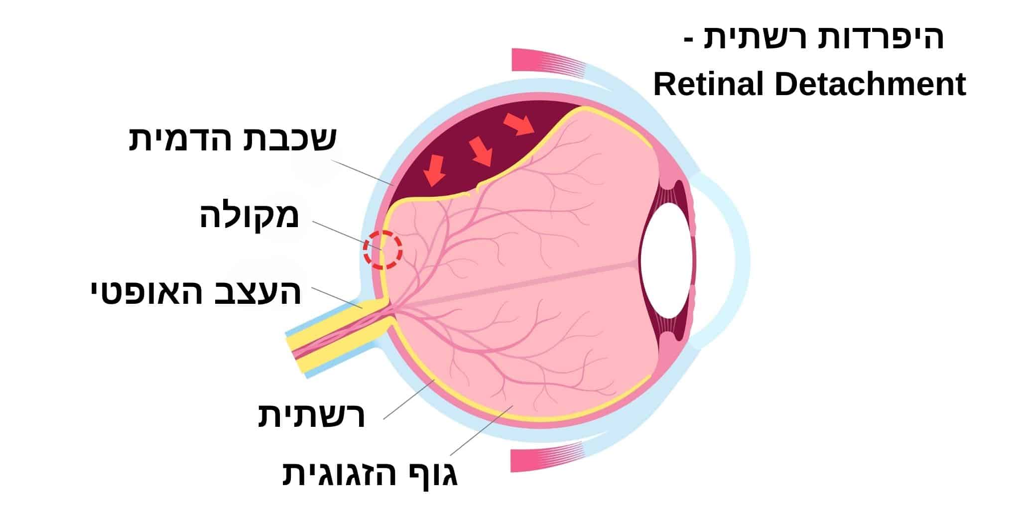 היפרדות רשתית – Retinal Detachment - ד"ר אליק רוזנפלד